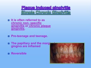 Conditioned gingivitis | PPT