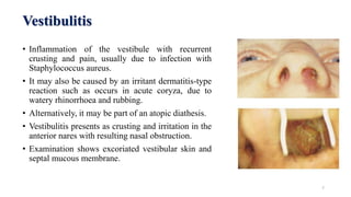 Nasal Vestibulitis