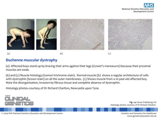 Conditions: Duchenne Muscular Dystrophy XL | PPT