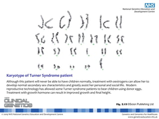 Conditions: Turner Syndrome Chrom | PPT