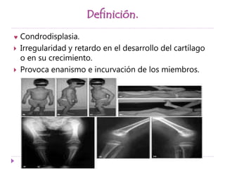 Condroplasia | PPTX