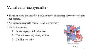 Conducting system of heart and ventricular arrhythmias | PPT