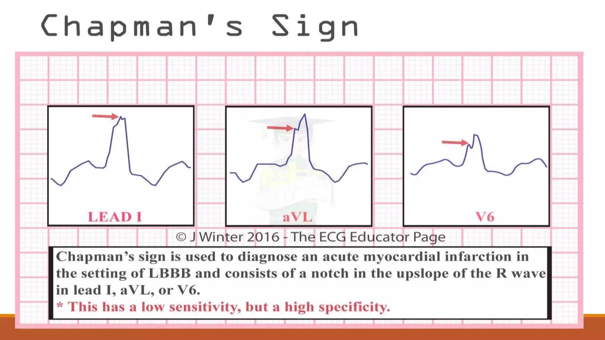 Conduction abnormalities part I | PPTX