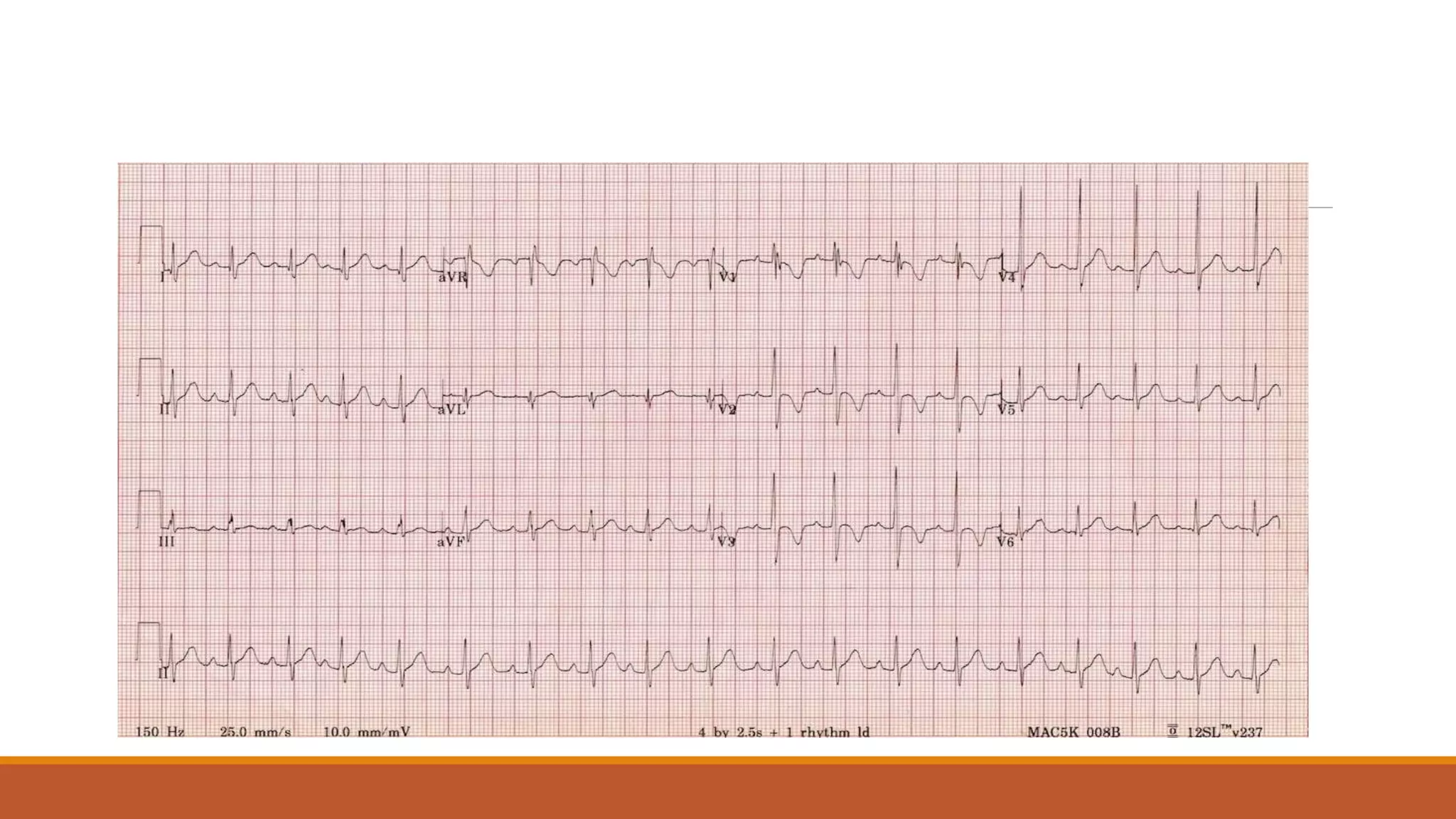 Conduction abnormalities part I | PPTX