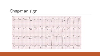 Conduction abnormalities part I | PPTX