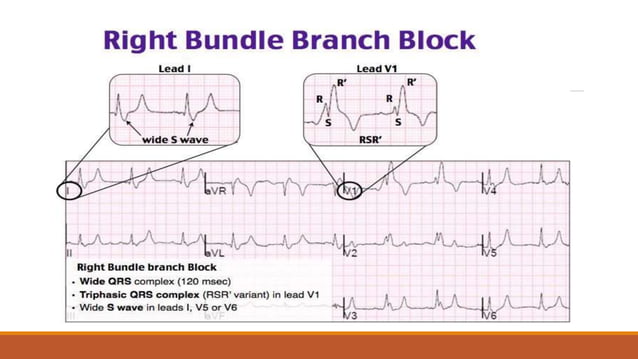 Conduction abnormalities part I | PPTX