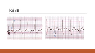 Conduction abnormalities part I | PPTX