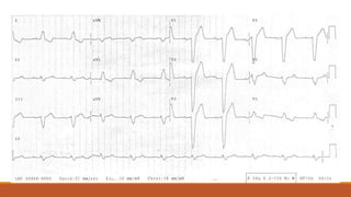 Conduction abnormalities part I | PPTX