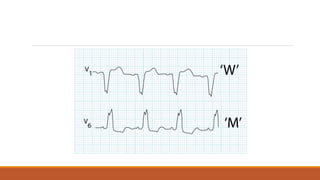 Conduction abnormalities part I | PPTX