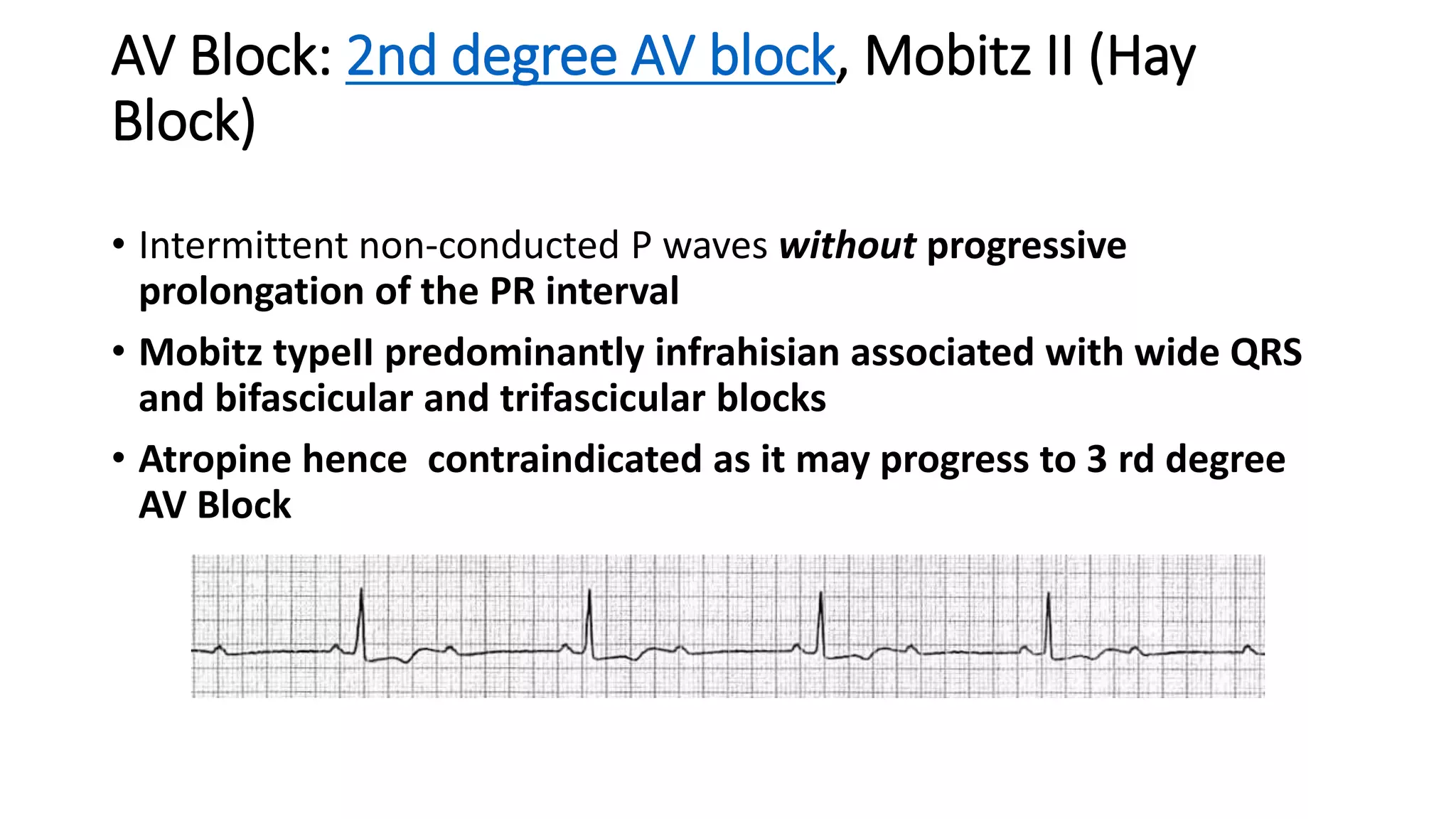 Conduction abnormalities part 2 | PPTX
