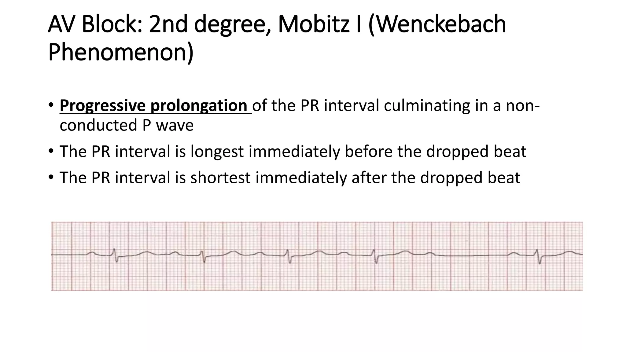 Conduction abnormalities part 2 | PPTX