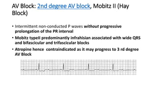Conduction abnormalities part 2 | PPTX