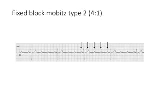 Conduction abnormalities part 2 | PPTX