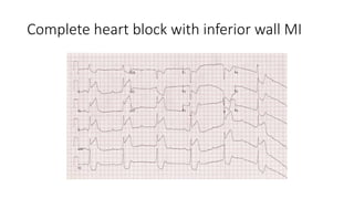 Conduction abnormalities part 2 | PPTX