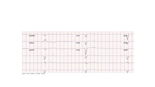 Conduction abnormalities part 2 | PPTX