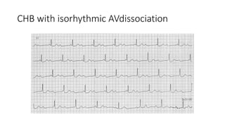 Conduction abnormalities part 2 | PPTX