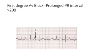 Conduction abnormalities part 2 | PPTX