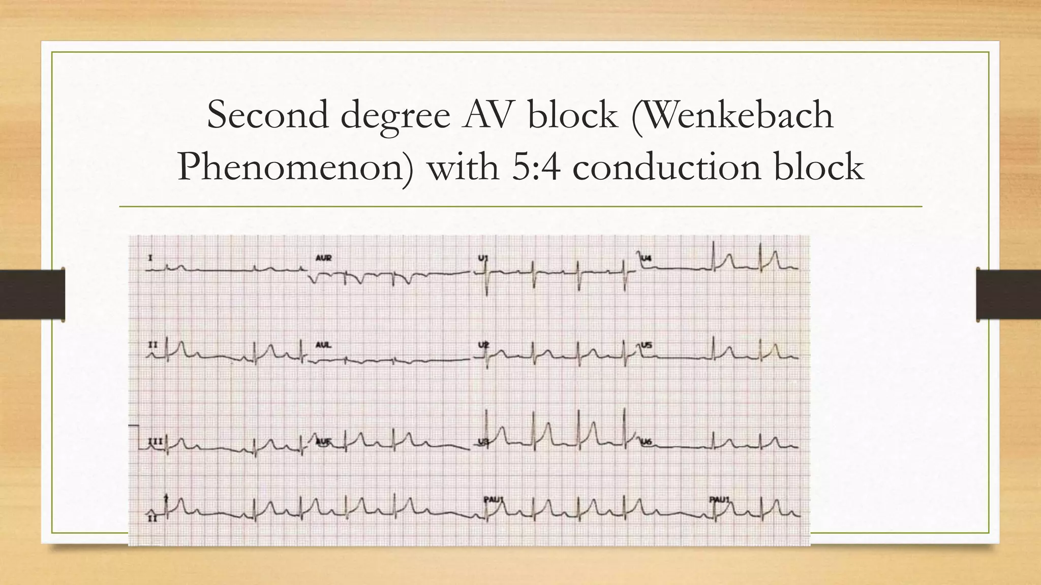 Conduction abnormalities part 2 | PPTX
