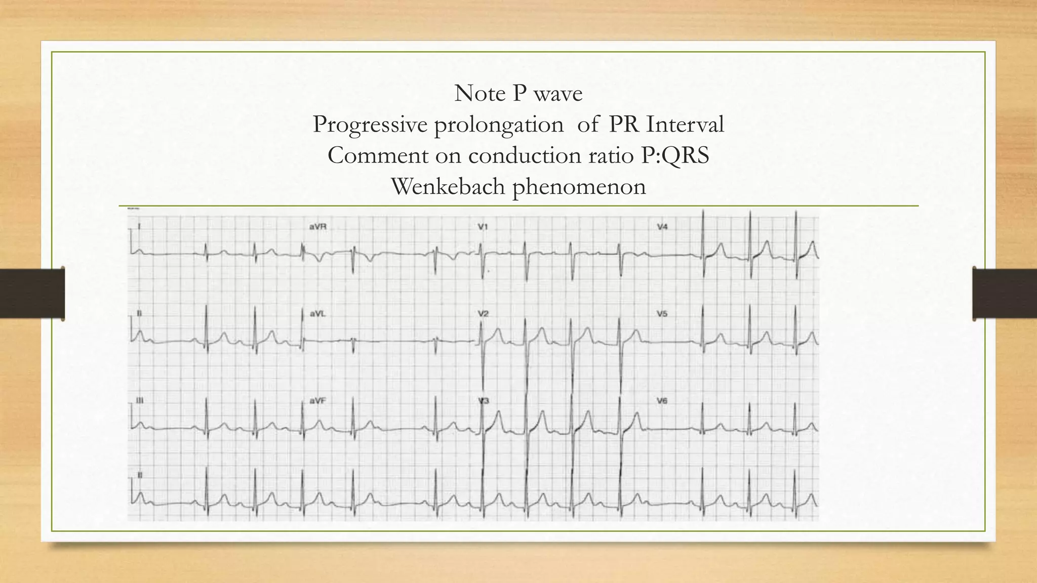 Conduction abnormalities part 2 | PPT | Free Download