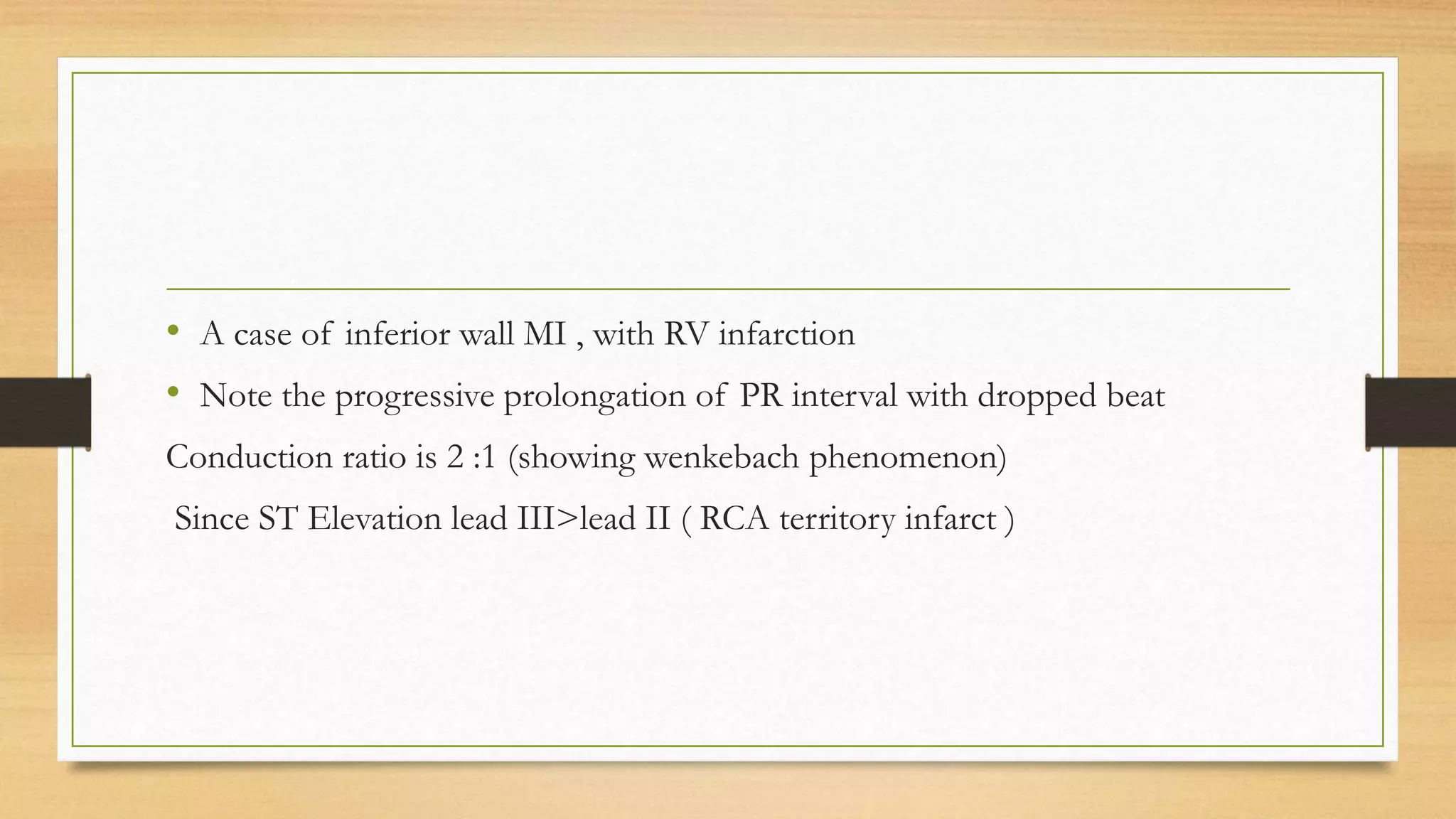 Conduction abnormalities part 2 | PPT | Free Download