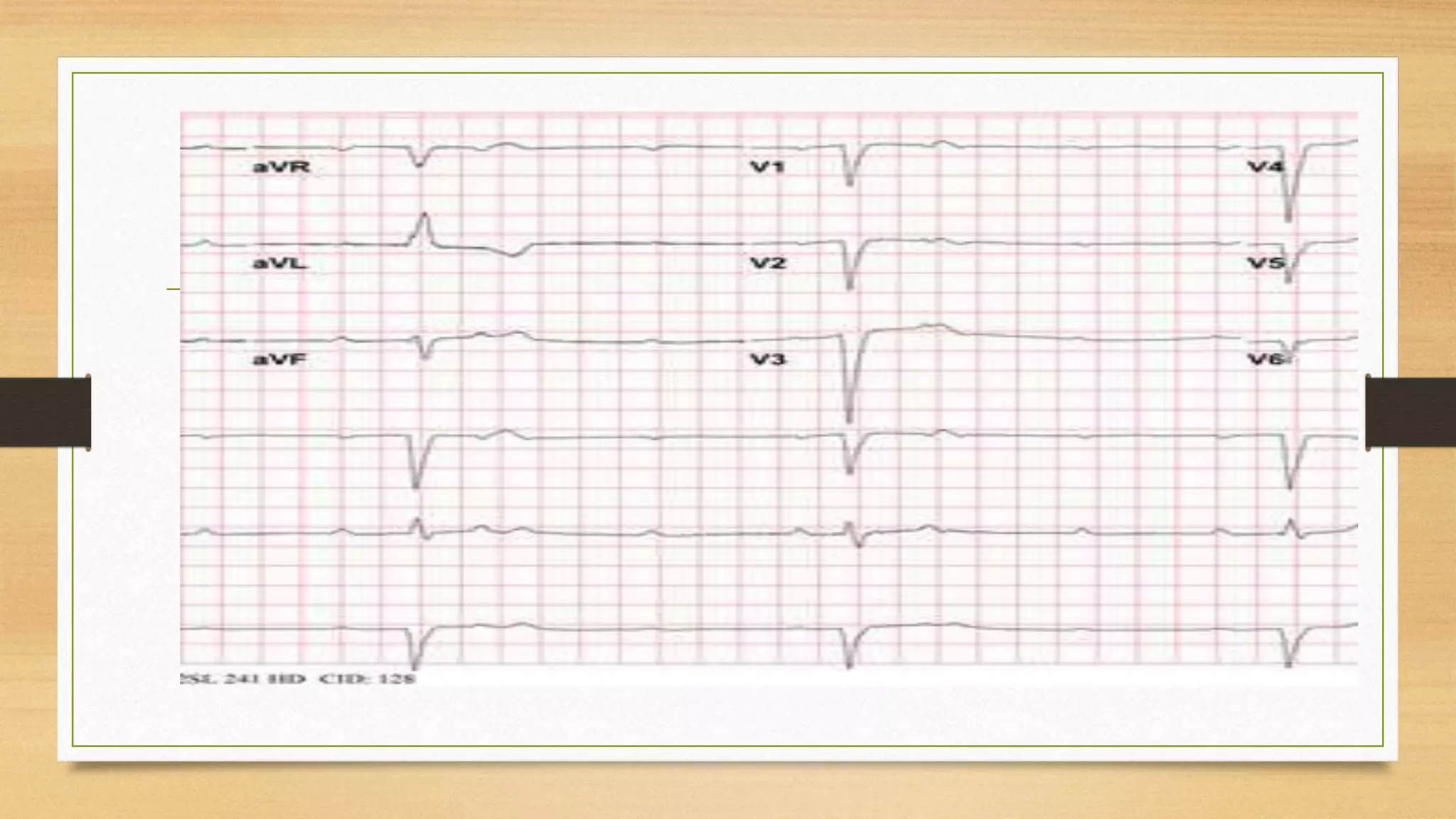 Conduction abnormalities part 2 | PPTX