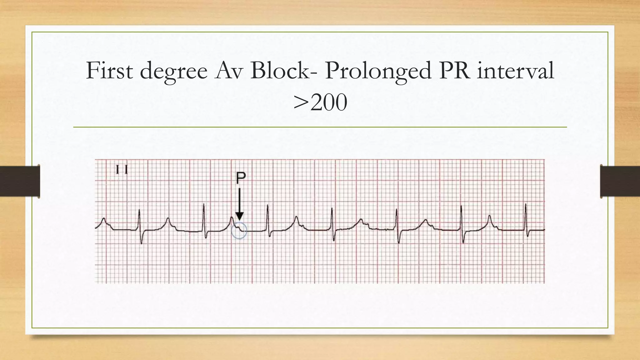 Conduction abnormalities part 2 | PPTX