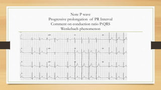 Conduction abnormalities part 2 | PPT | Free Download