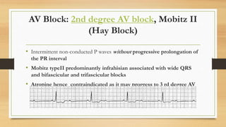 Conduction abnormalities part 2 | PPT | Free Download