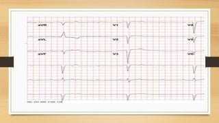 Conduction abnormalities part 2 | PPT | Free Download
