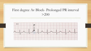 Conduction abnormalities part 2 | PPT | Free Download