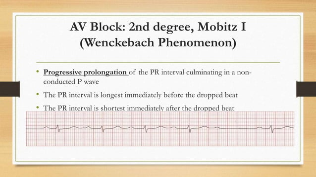 Conduction abnormalities part 2 | PPT | Free Download
