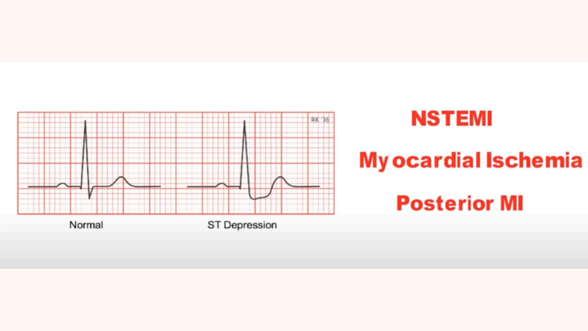 Conduction and its abnormalities .pdf