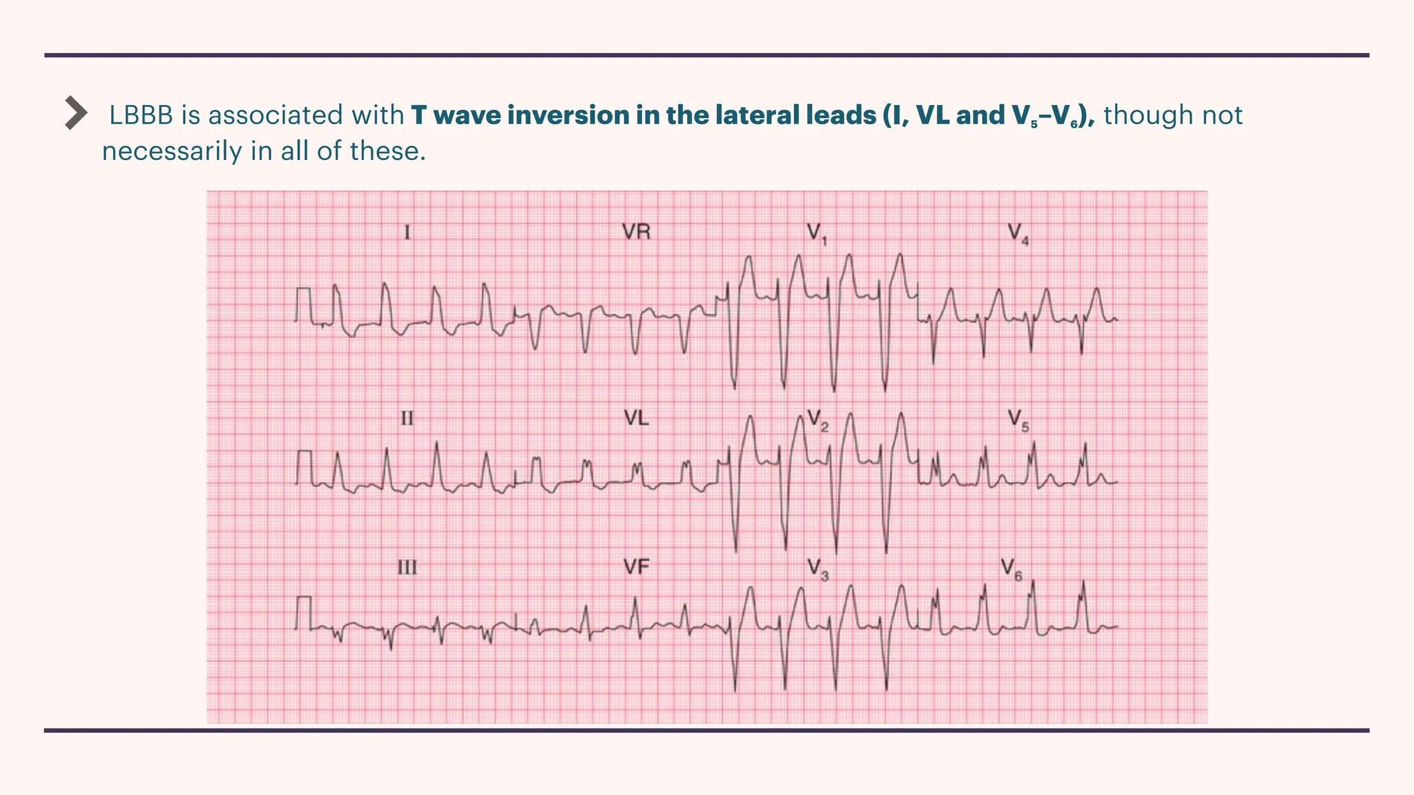 Conduction and its abnormalities .pdf