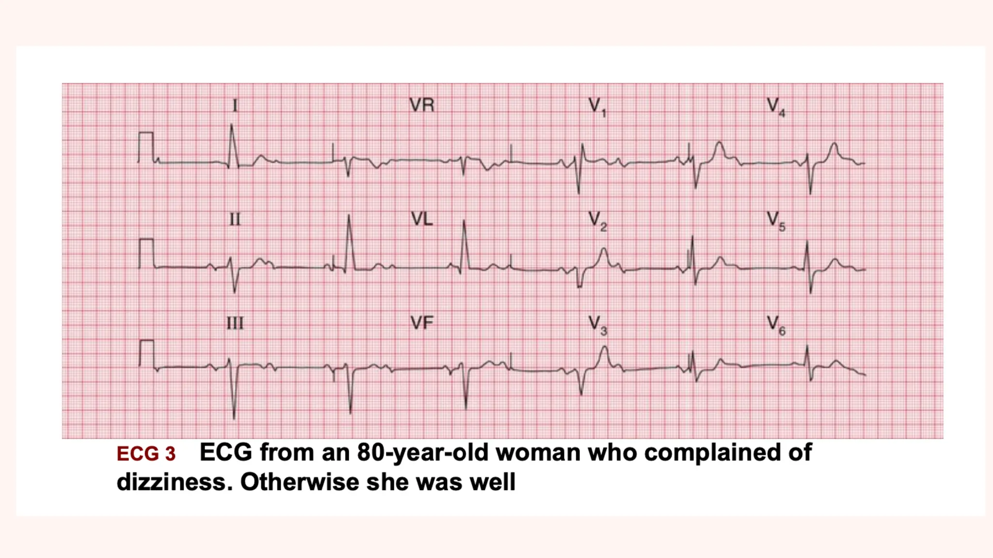 Conduction and its abnormalities .pdf