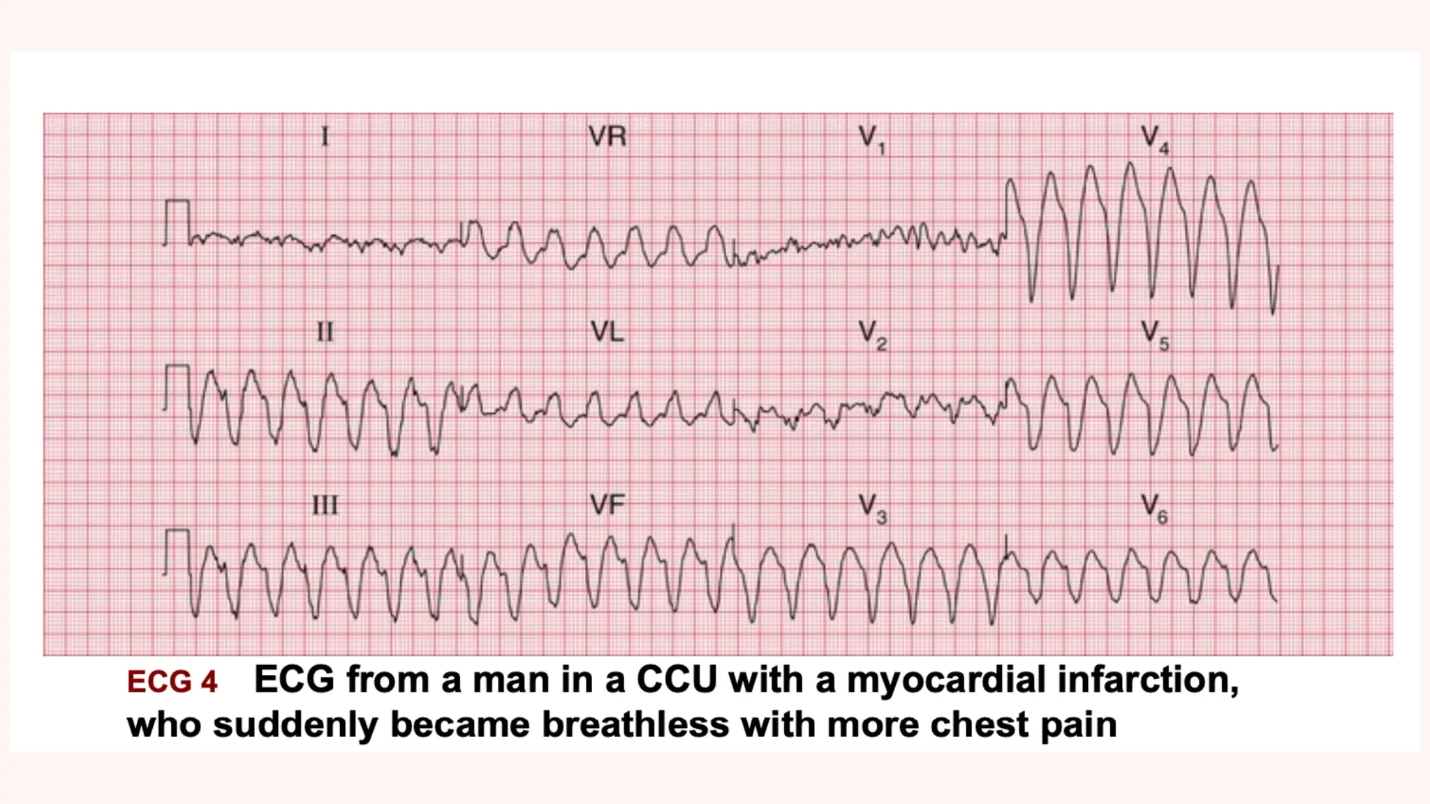 Conduction and its abnormalities .pdf