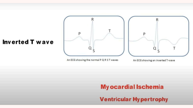 Conduction and its abnormalities .pdf