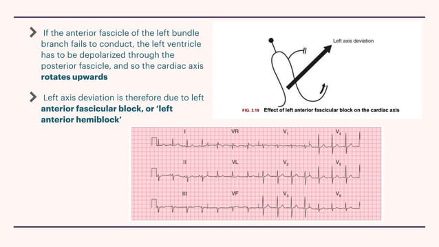 Conduction and its abnormalities .pdf