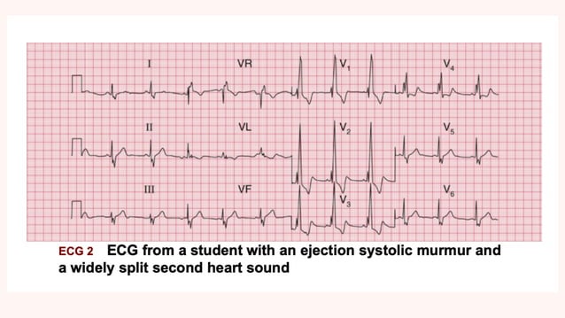 Conduction and its abnormalities .pdf