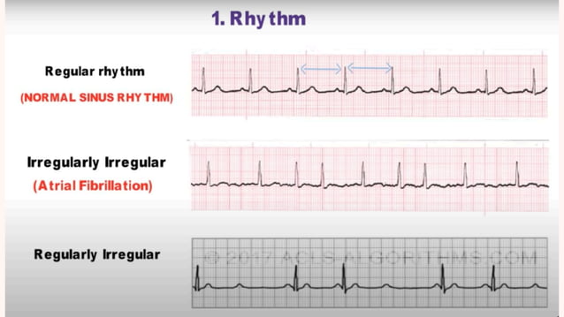 Conduction and its abnormalities .pdf