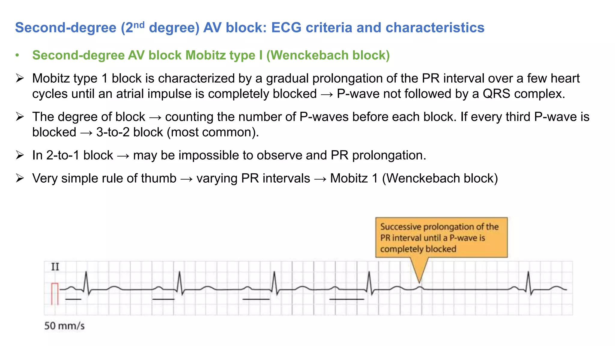 ECG - Conduction defects - Hoang Van Cuong HMU | PPT