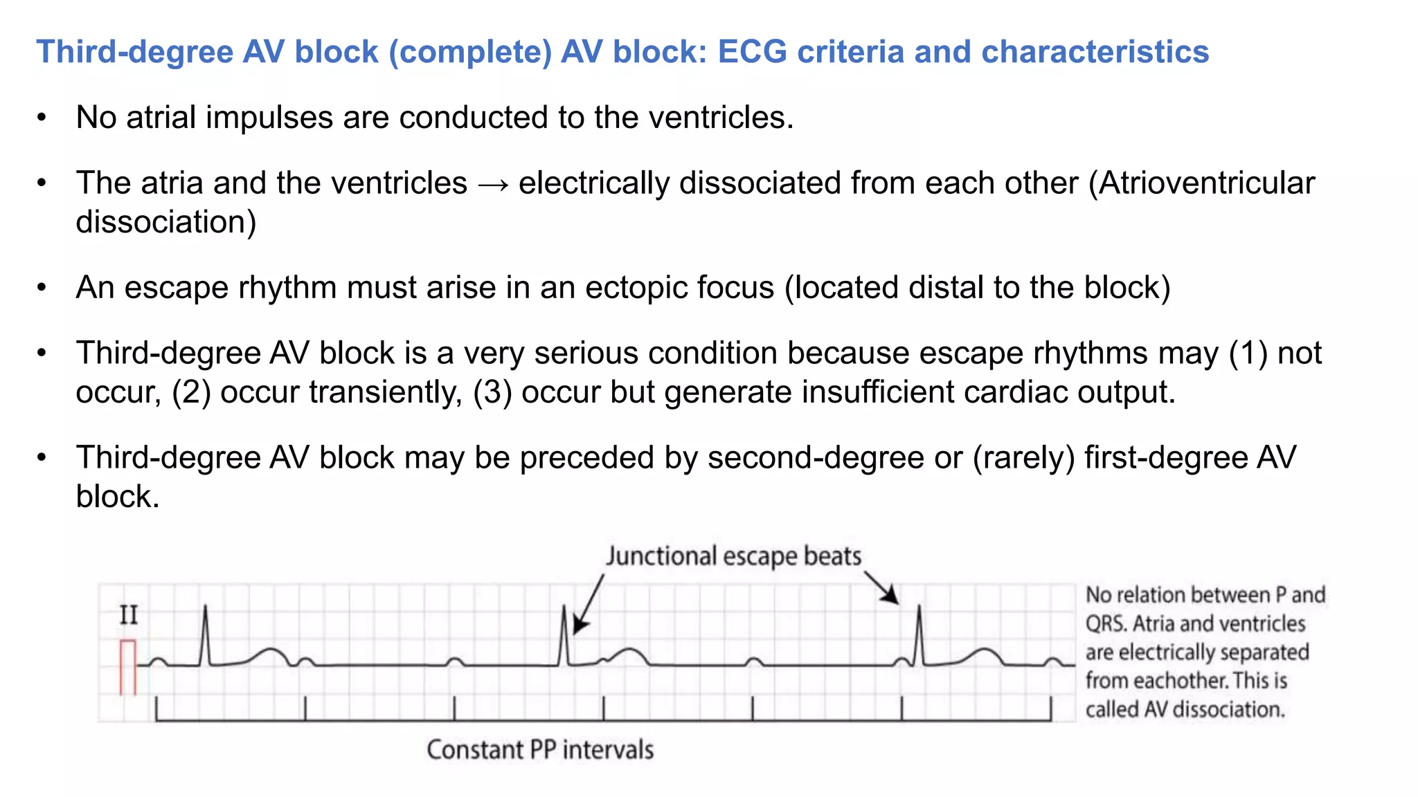 ECG - Conduction defects - Hoang Van Cuong HMU | PPT