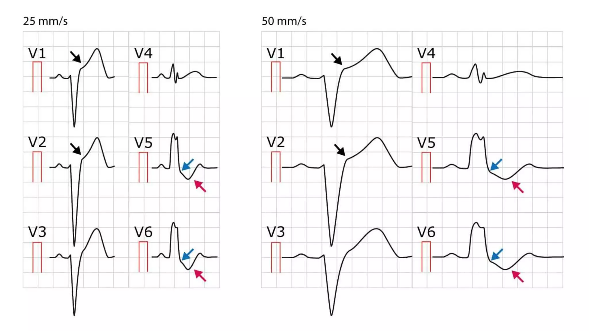 ECG - Conduction defects - Hoang Van Cuong HMU | PPT