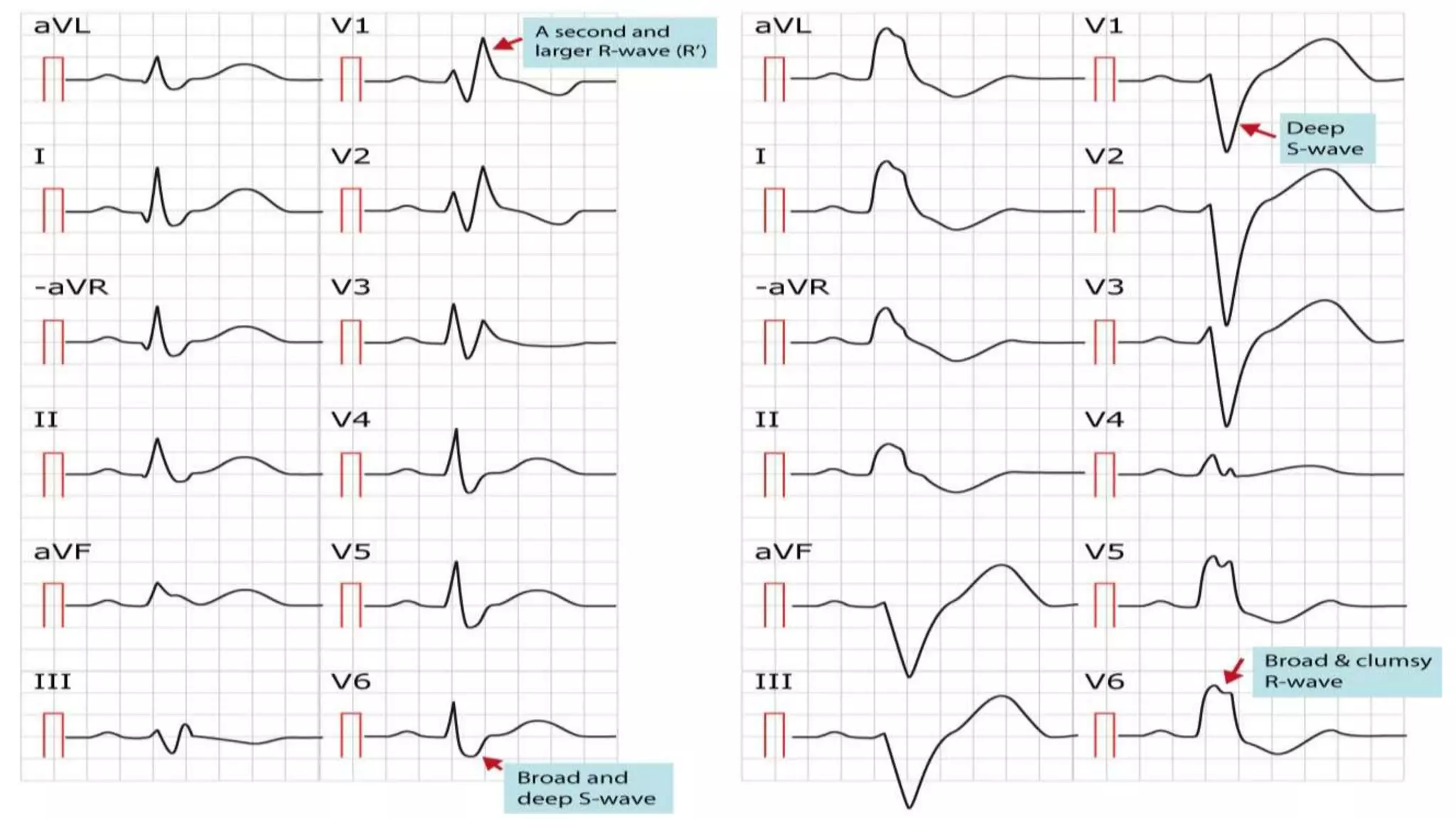 ECG - Conduction defects - Hoang Van Cuong HMU | PPT