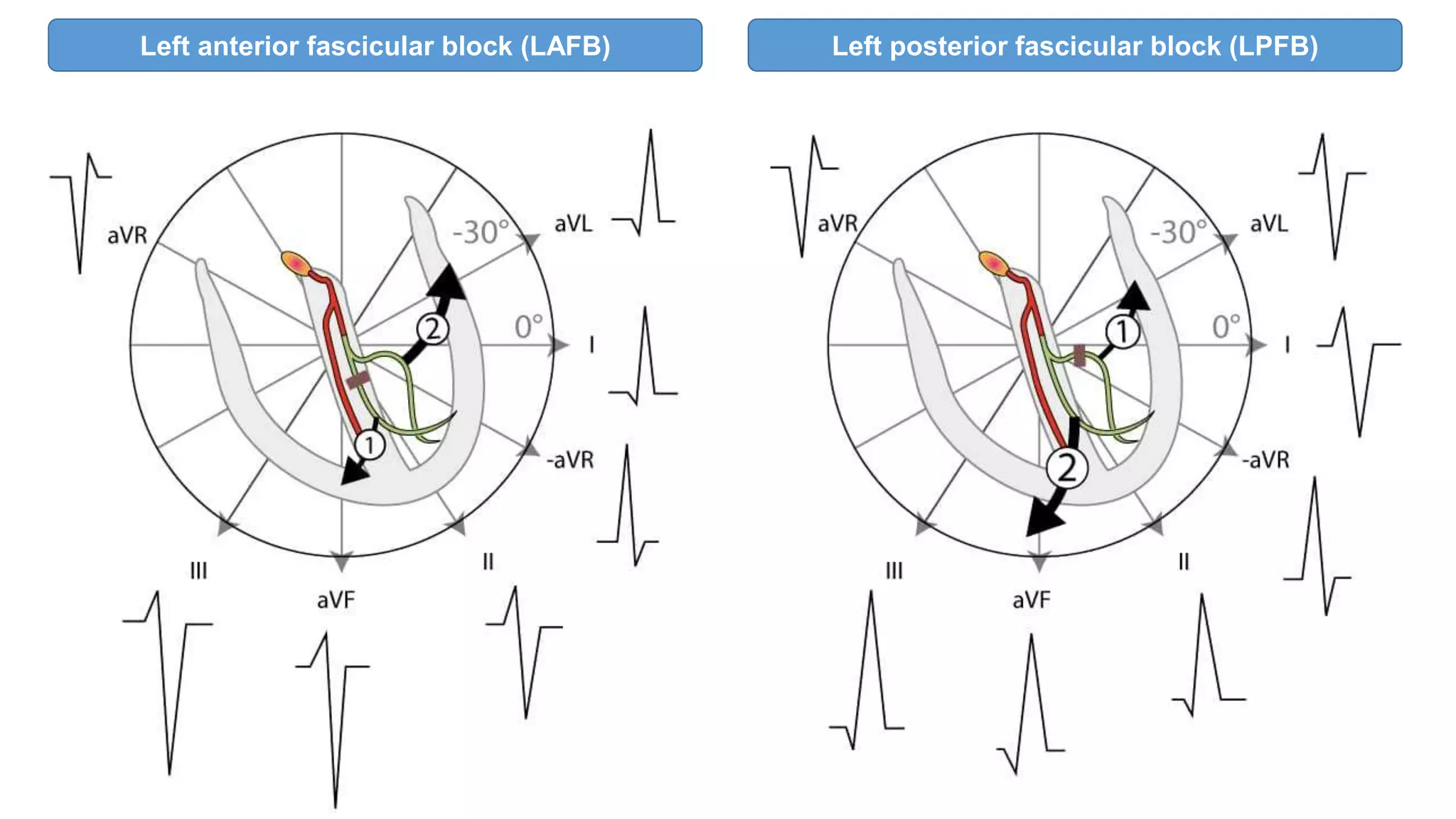 ECG - Conduction defects - Hoang Van Cuong HMU | PPT