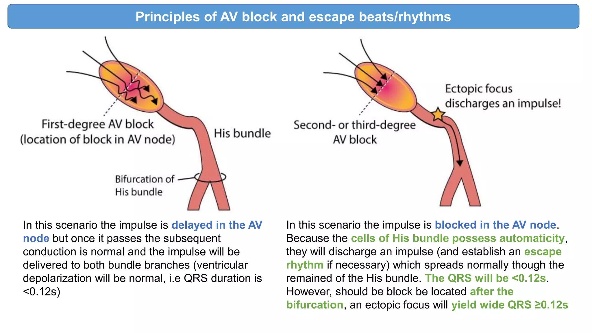 ECG - Conduction defects - Hoang Van Cuong HMU | PPT