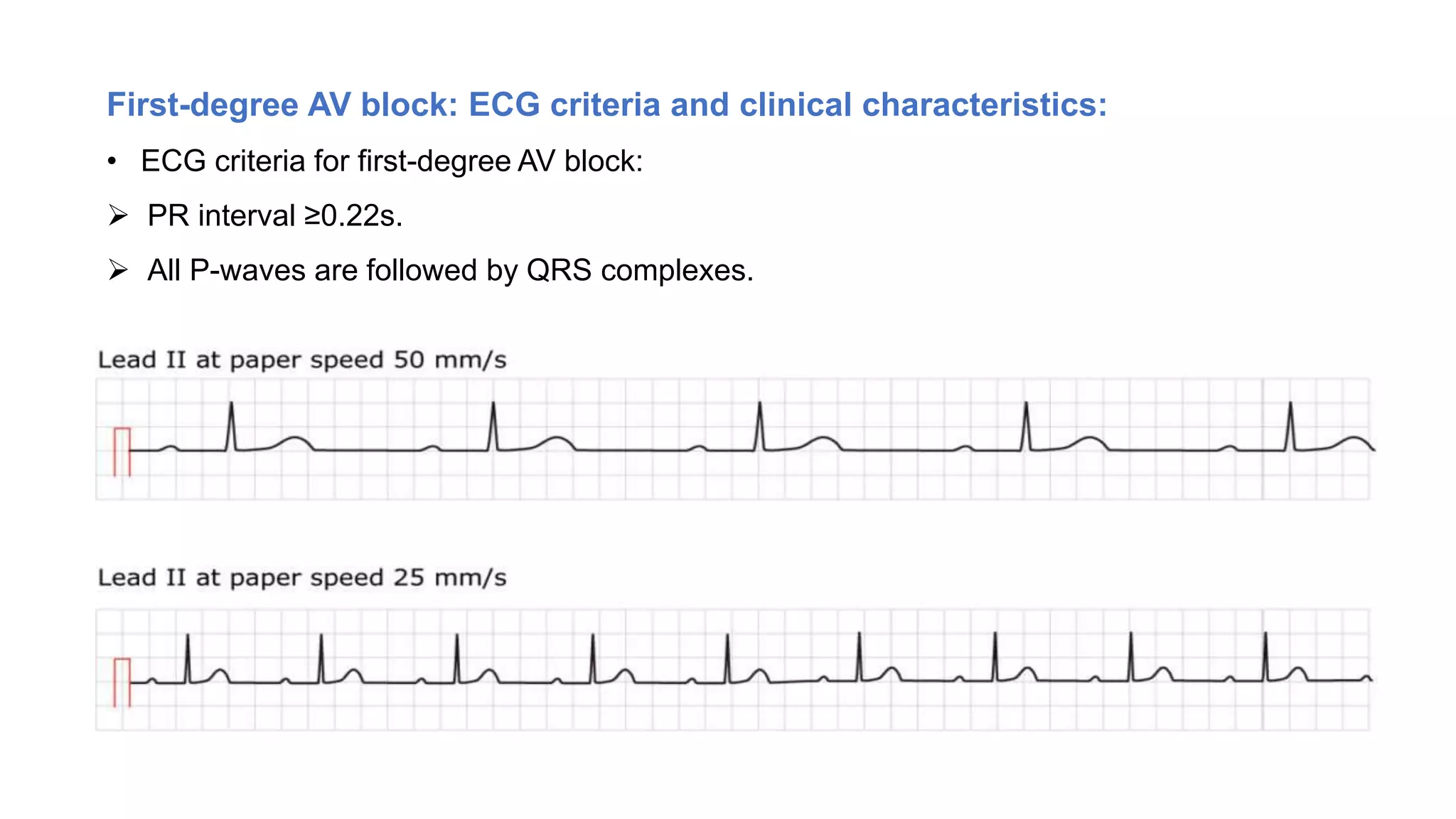 ECG - Conduction defects - Hoang Van Cuong HMU | PPT