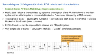 ECG - Conduction defects - Hoang Van Cuong HMU | PPTX