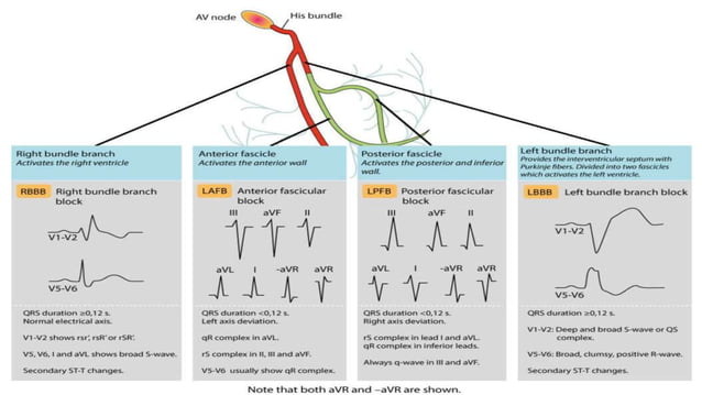 ECG - Conduction defects - Hoang Van Cuong HMU | PPT