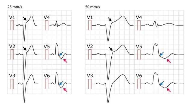 ECG - Conduction defects - Hoang Van Cuong HMU | PPT