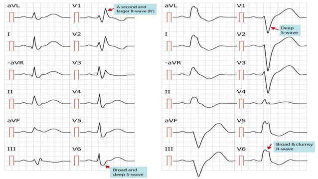 ECG - Conduction defects - Hoang Van Cuong HMU | PPT